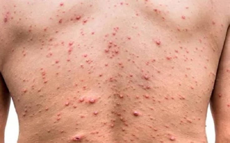 Variole du singe en Turquie : qu’en est-il vraiment